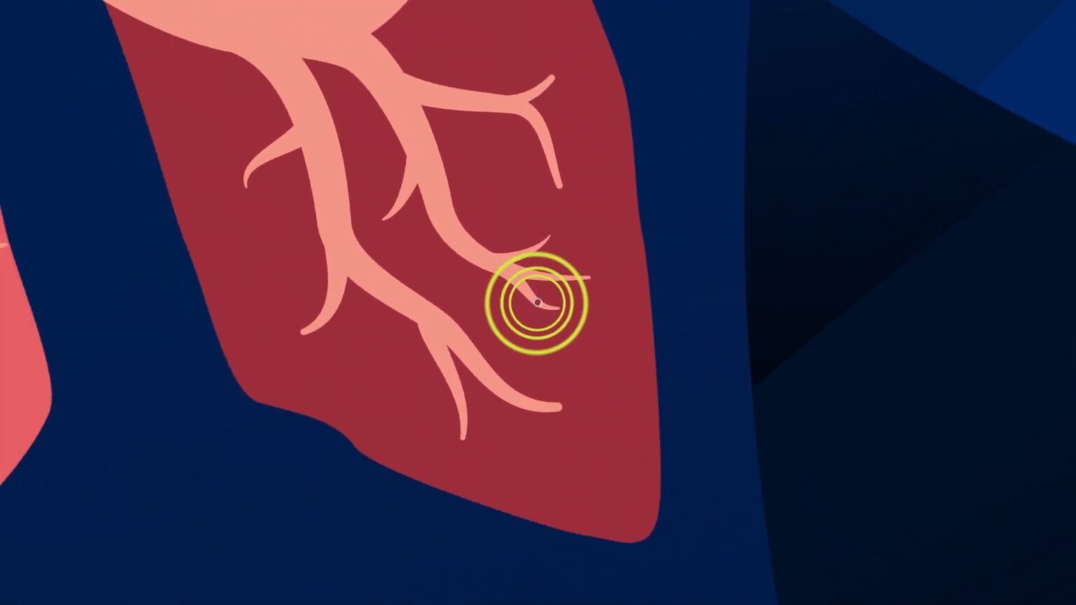 Is Asthma an Autoimmune Disease? Insights, Research, and Personal ...